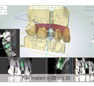 Nhakhoaimplant,vatlieuimplant,implant3D,mayin3Dnhakhoa,nhuanhakhoa3D